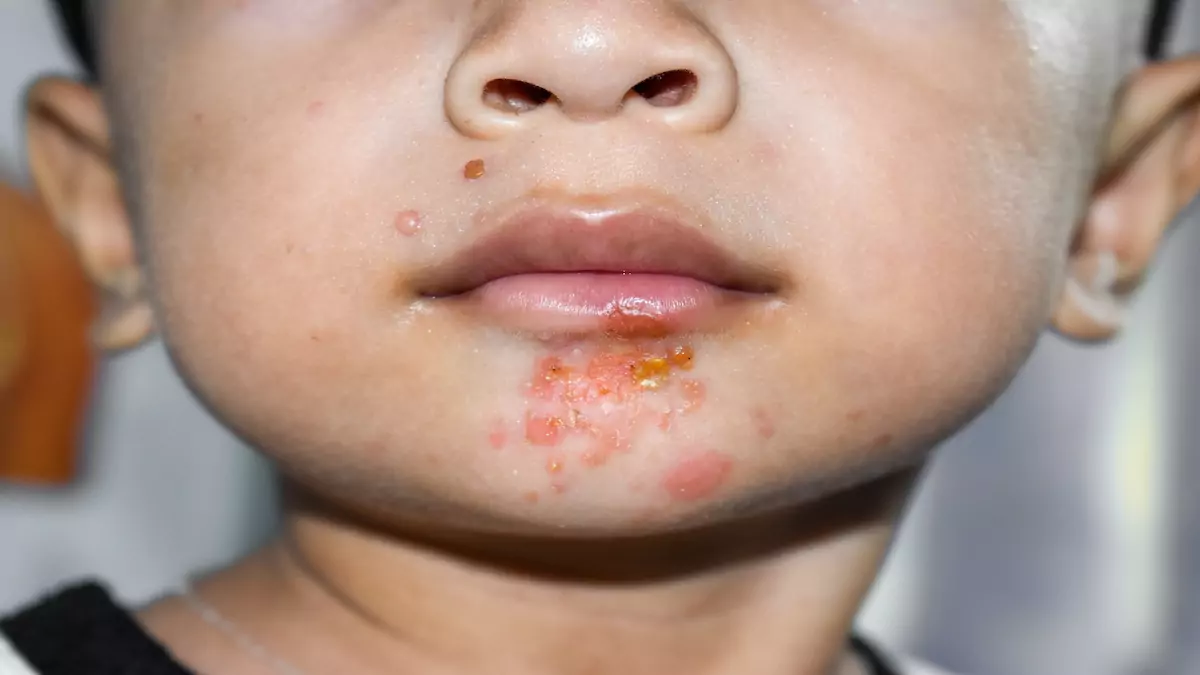 Impetigo Na Boca